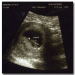 7 Weeks Pregnant - Fetal Development, Symptoms, Belly, Diary