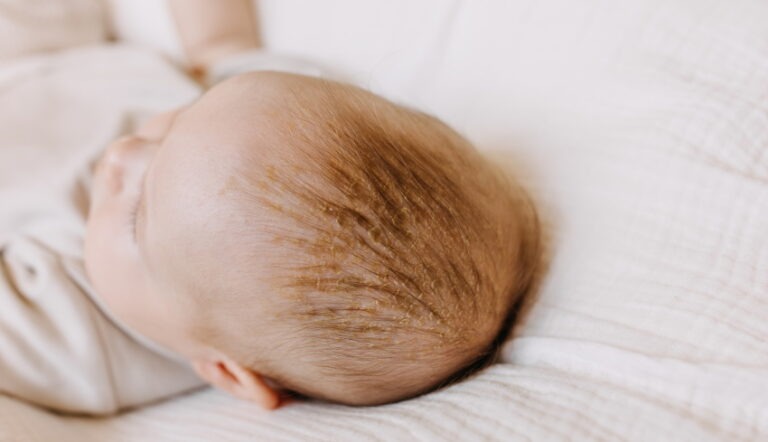 Baby Cradle Cap: Symptoms, Causes, Treatments, 7 FAQs